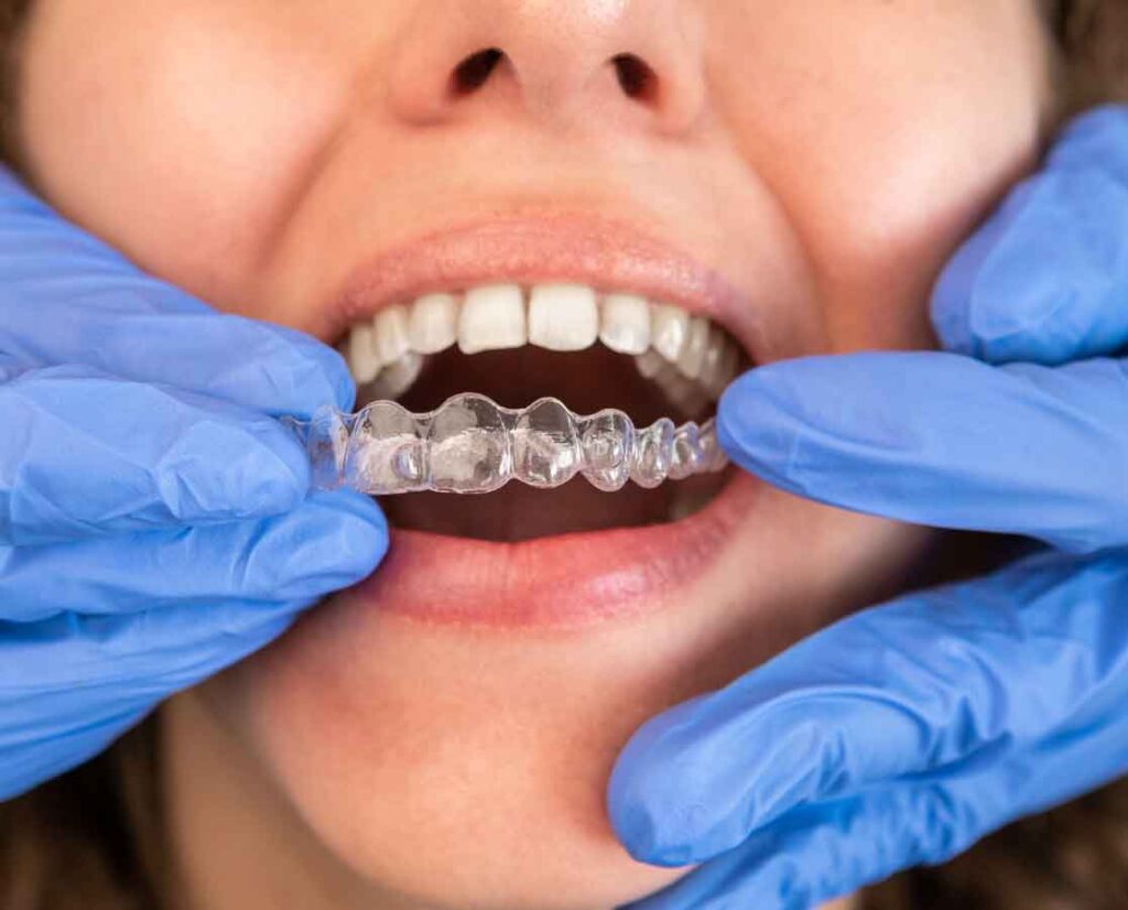 Invisalign in Irvine, CA | Achieve Your Perfect Smile with Expert Care